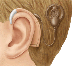 Implantes cocleares: beneficiaría a adultos con pérdida auditiva ...